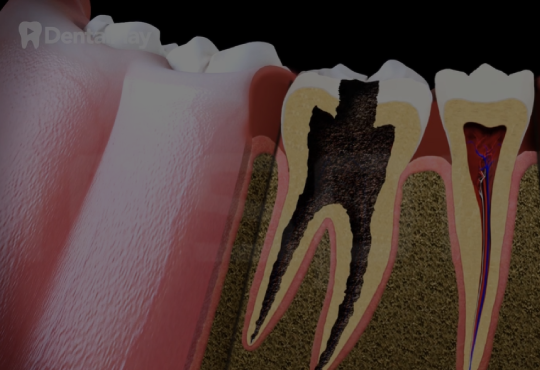 Endodoncia - Tratamiento para Caries Profunda - Inspiria