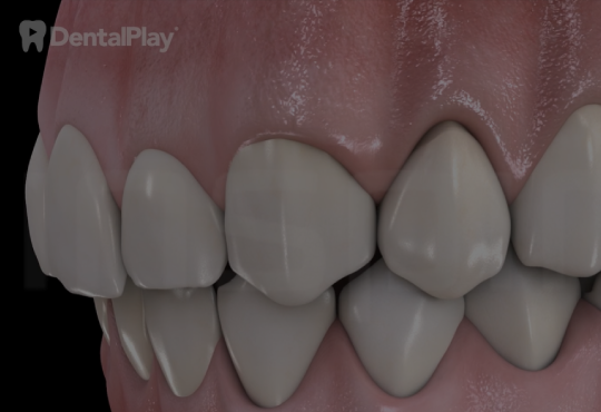 Abfración, Abrasión, Atrición, Erosión y Reabsorción - Inspiria