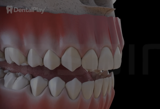 Avulsión Dental - Cómo Reimplantar un Diente Caído - Inspiria
