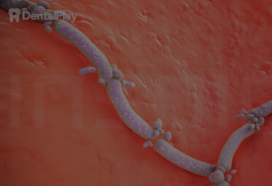 Candidiasis Oral y Queilitis Angular - Inspiria